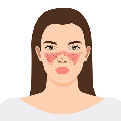 Researchers Identify a Disease-Causing Immune Cell Imbalance in Lupus ...